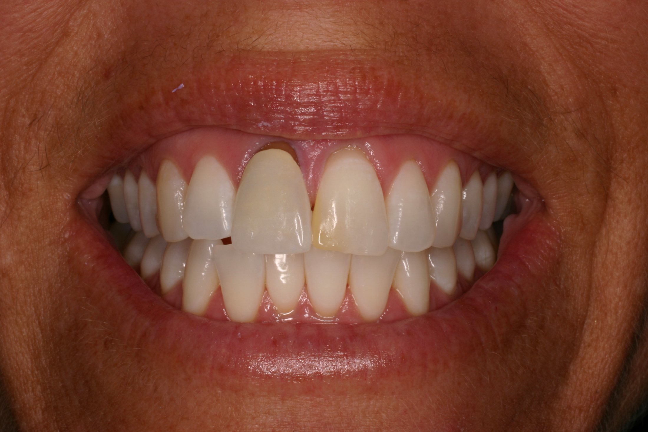 Before & After Dental Photos Springfield OR | Smile Gallery