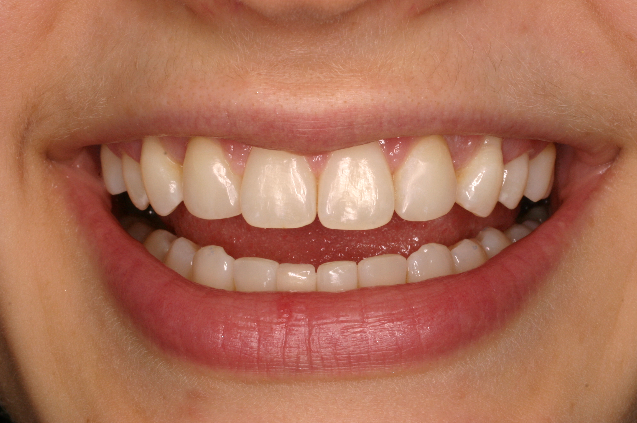 Dental Implants Springfield OR | Missing Teeth Replacement